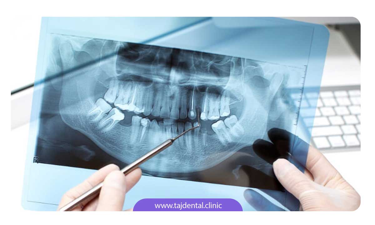 هزینه عکس دندان (OPG و CBCT) در سال 1404 چقدر است؟ - دندانپزشکی شبانه روزی تاج